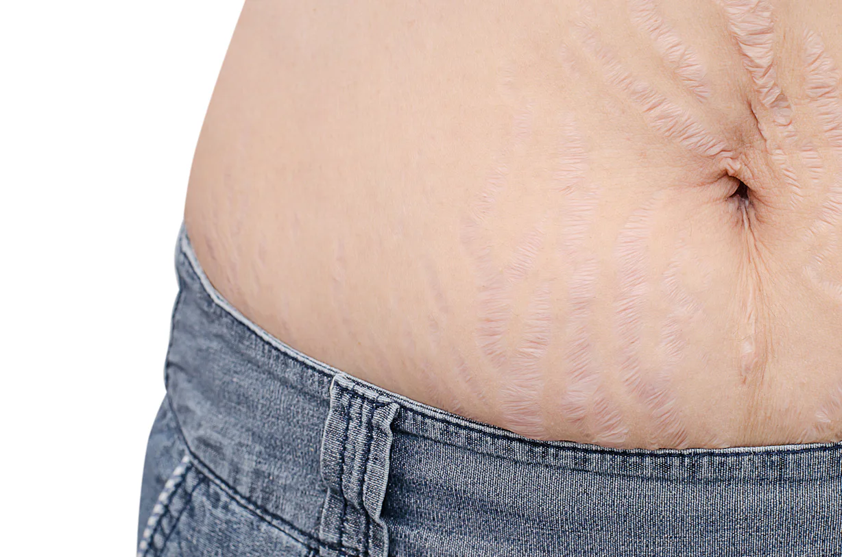 11 Things My Postpartum Stomach Looked Like, Because Loving Your Body ...