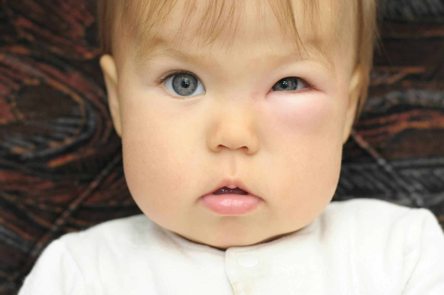 7 Signs of Frostbite In Babies That Should Be Noticed As Early As Possible