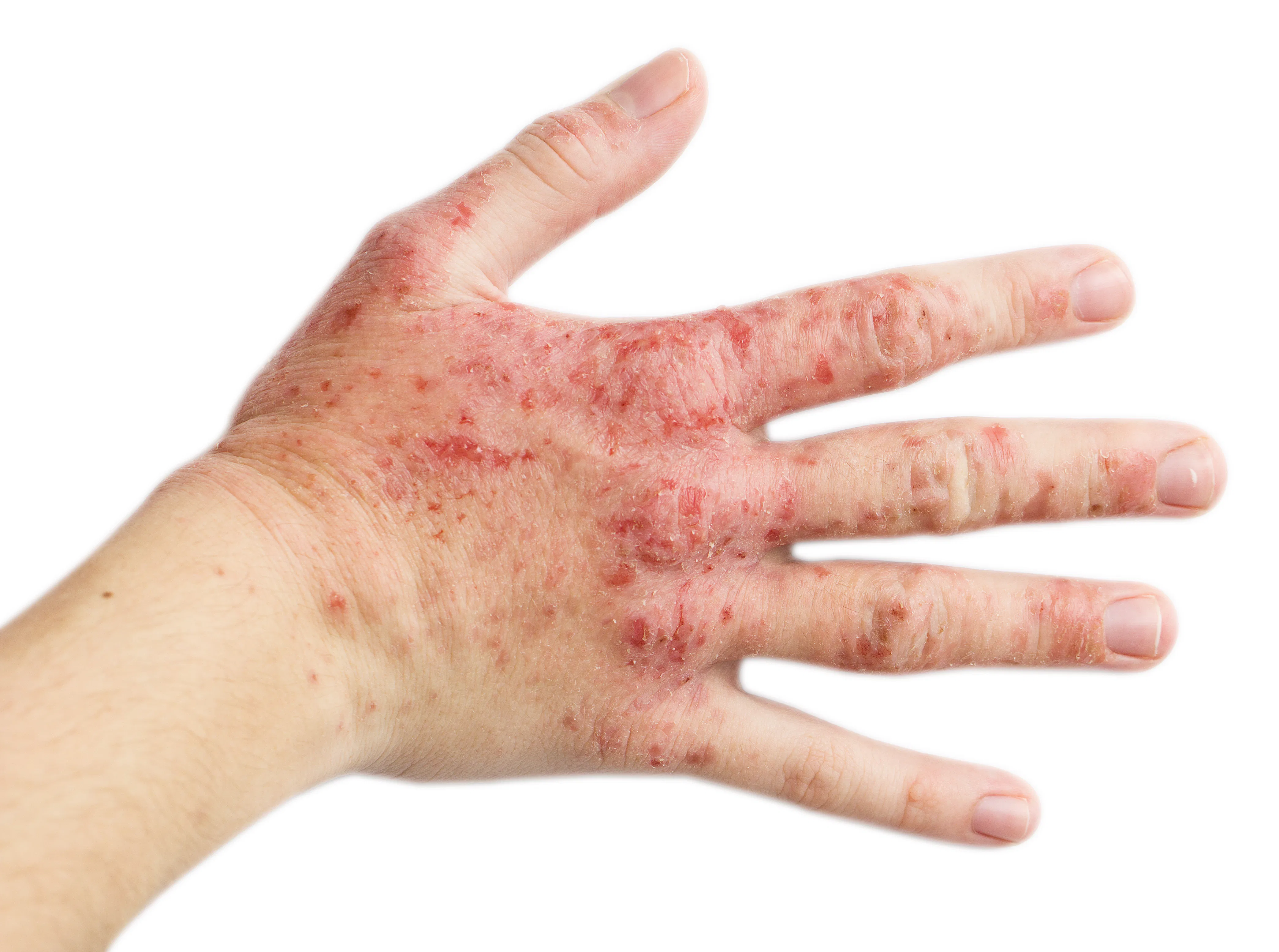5 Signs Of Sun Poisoning, Since It's Not The Same Thing As Sunburn