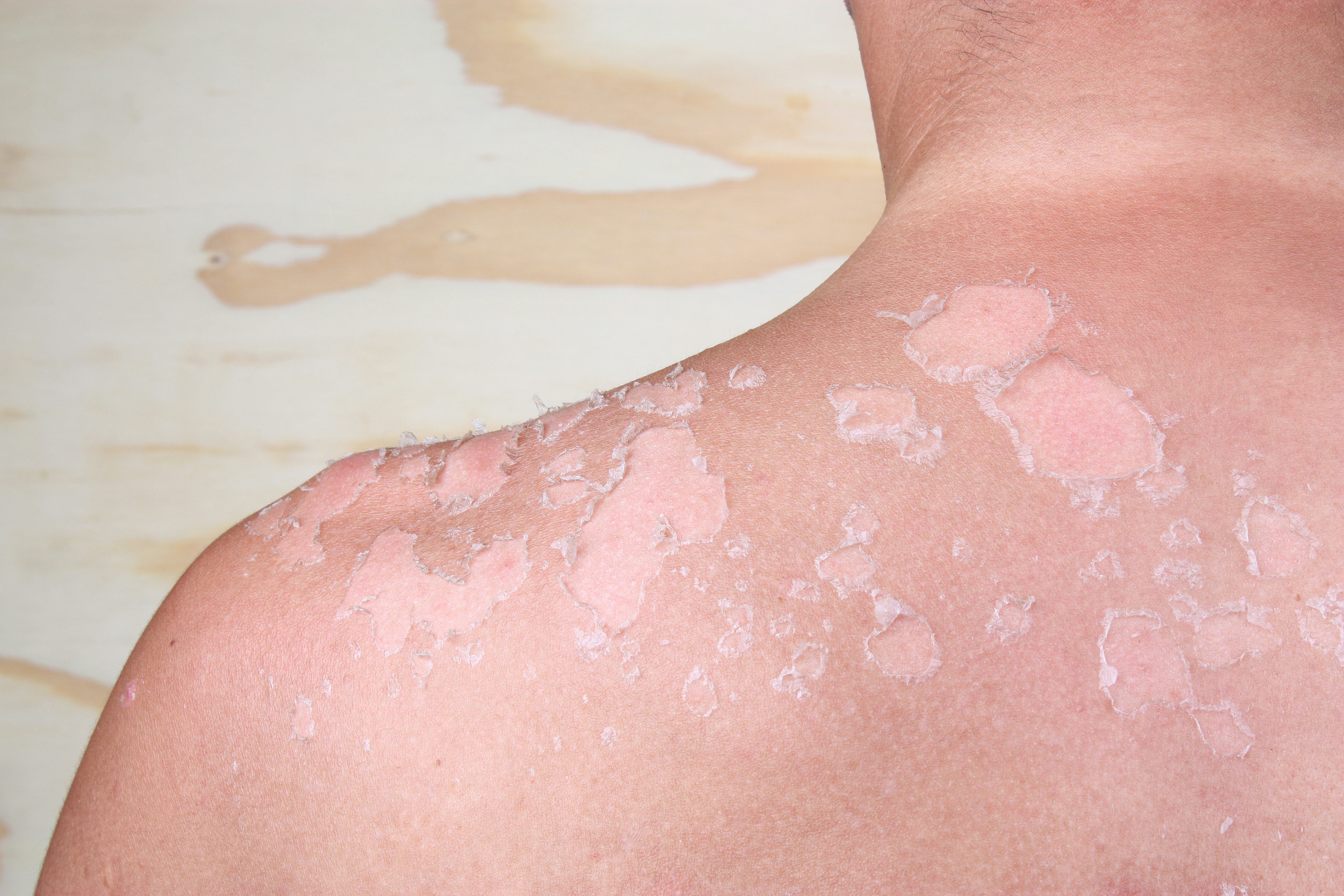 5 Signs Of Sun Poisoning, Since It's Not The Same Thing As Sunburn