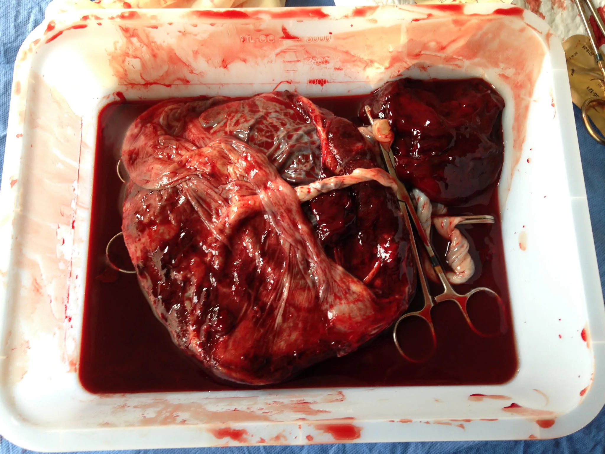 13 Dads Describe What A Placenta Really, Actually Looks Like