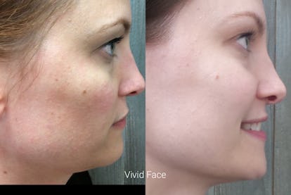 I Got A Laser Facial In Miami Like A Celebrity Goddess & Here's ...