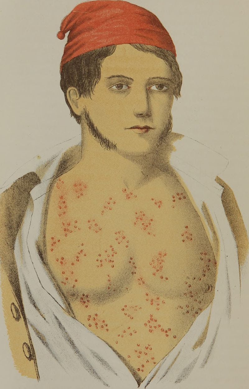 Bizarre STD Treatments From History