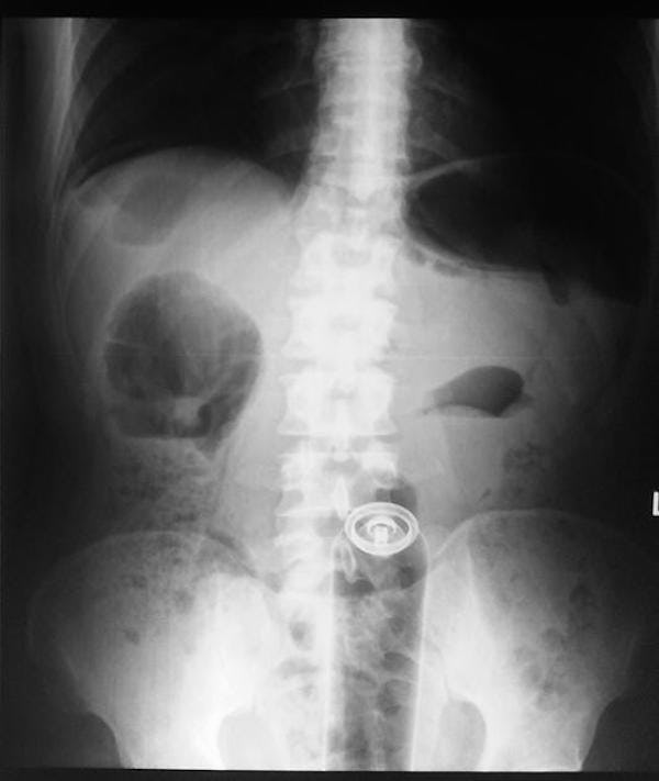 Website Compiles X-Ray Photos Of Weird Things Stuck Up People's Butts