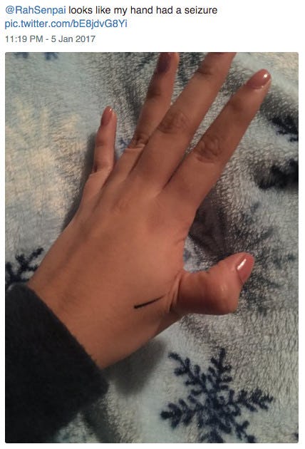 Scary Meme Claims To Show You How To Break Your Thumb