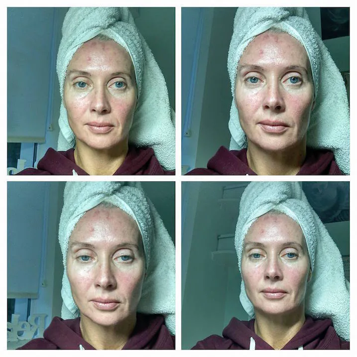 Woman's Before-And-After Pics Show Treatment Post-Tanning