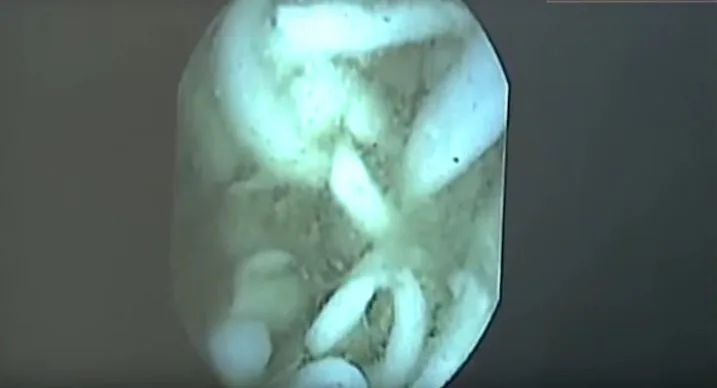Video Of Ramen Noodles Inside Stomach Is Gross