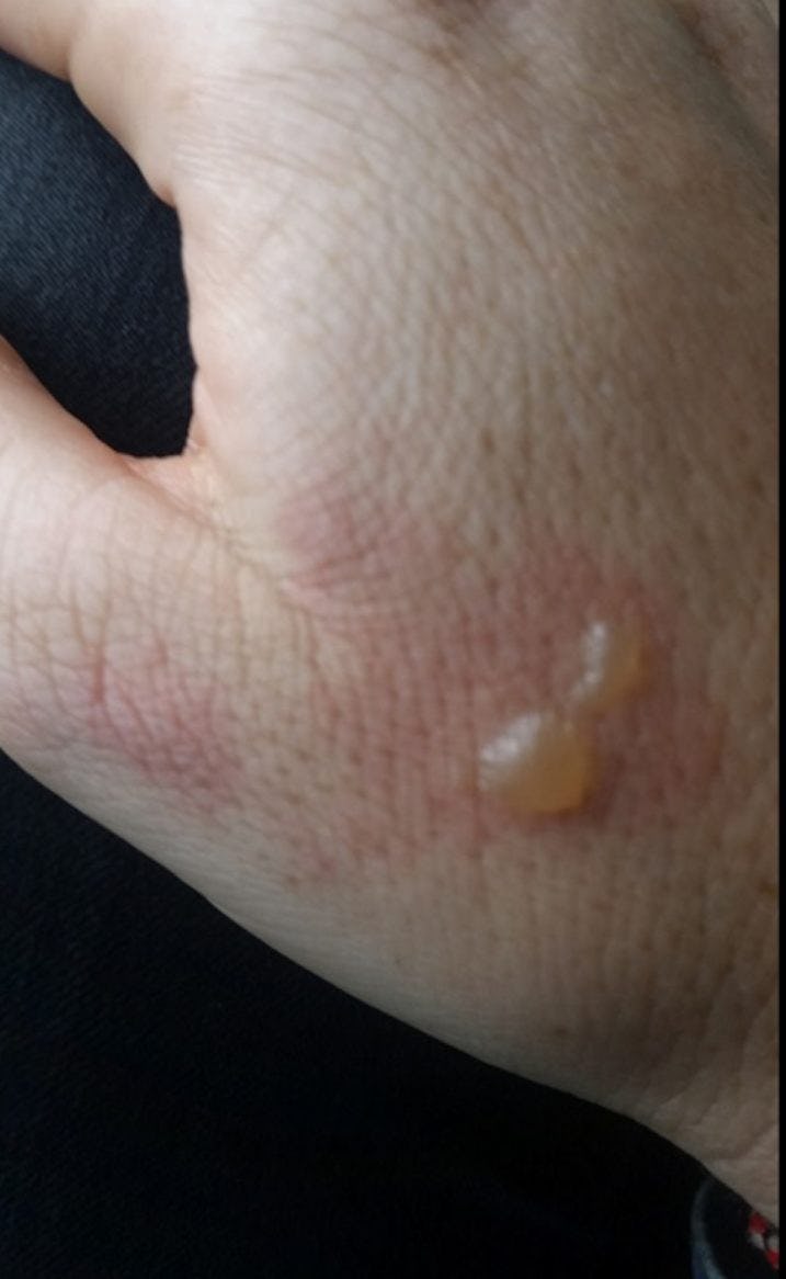 Woman's Headphones Explode In Her Ears On Airplane