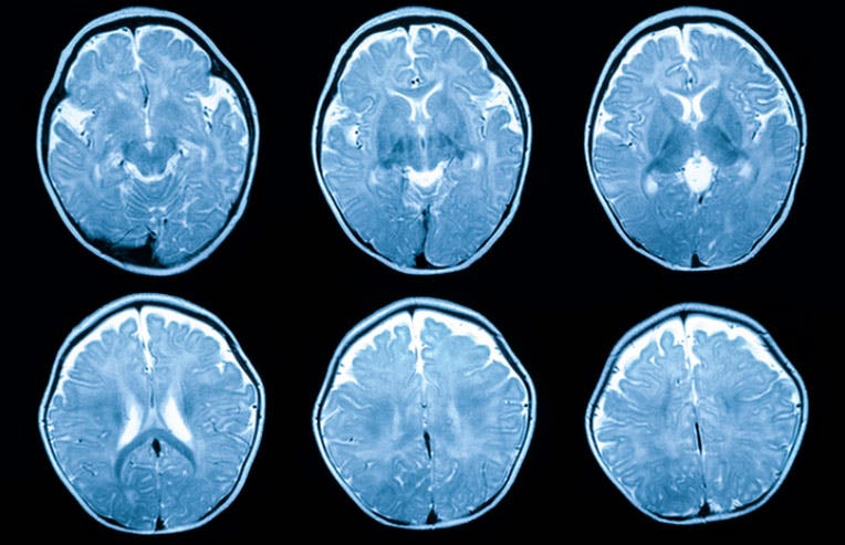 Neuroscientist Can Now Track Baby Pain Through Brain Scans