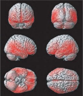 726 teen brains show alcohol had one surprising, long-term effect