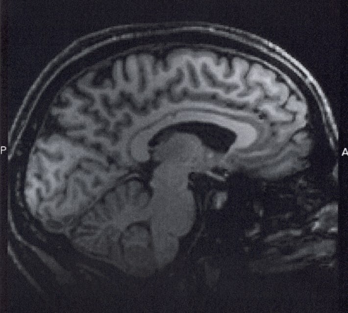 CBT for Depression: Brain Scans Show Why It Doesn't Help Some Patients