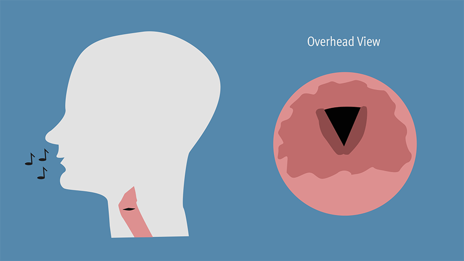 Vocal Cord Tissue Implant Could Help Treat Voice Disorders
