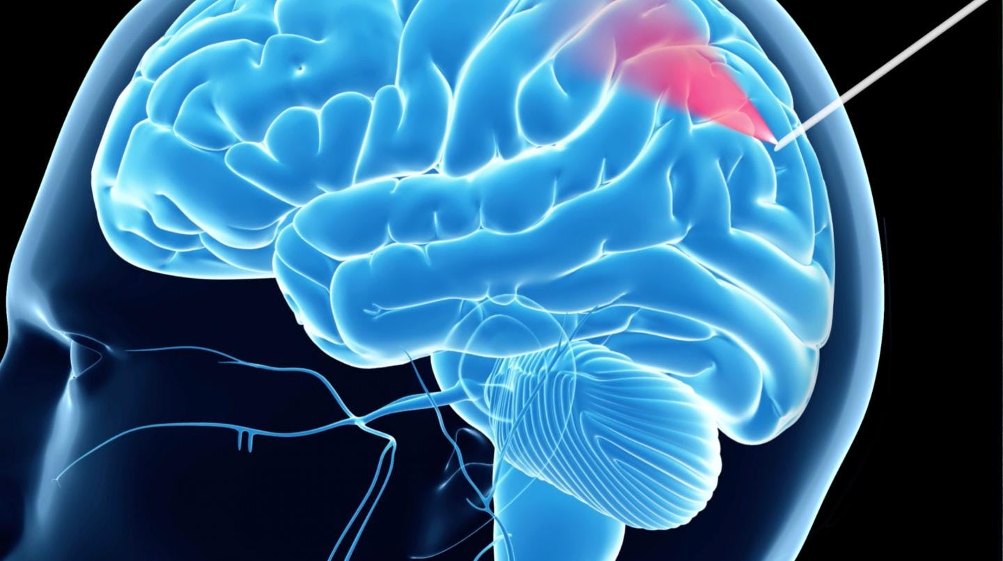 Video Shows Innovative "Brain Needle" With a Surprise Feature