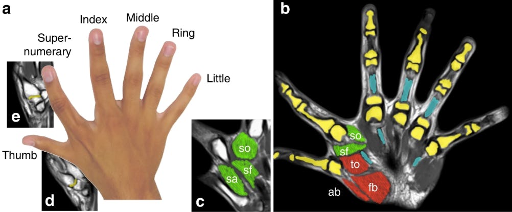 Six-fingered people exemplify why an extra digit means a better hand