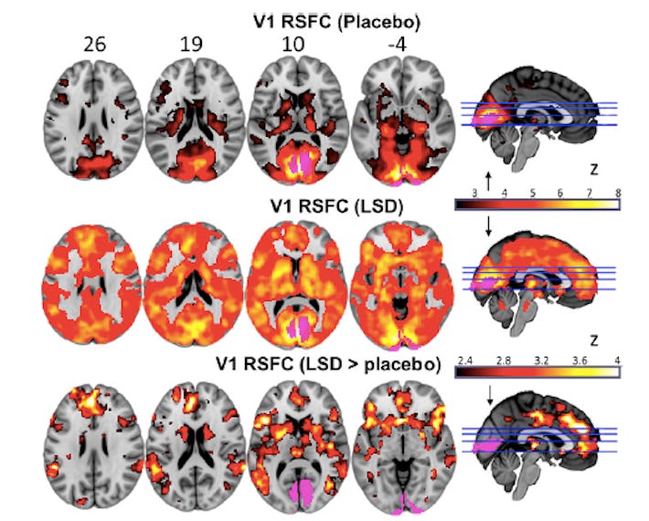 New Brain Images Show How LSD Affects Our Minds
