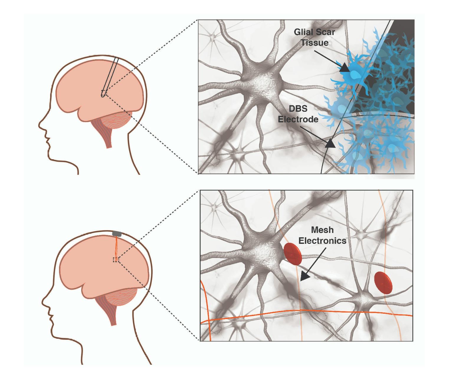 Brain Implants Like Elon Musk's Neuralink Could Change Humanity Forever