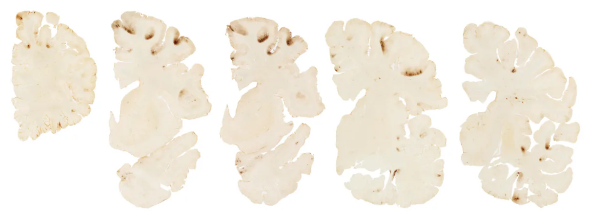 NFL-Funded Study Identifies Positions Most at Risk of Brain Injury