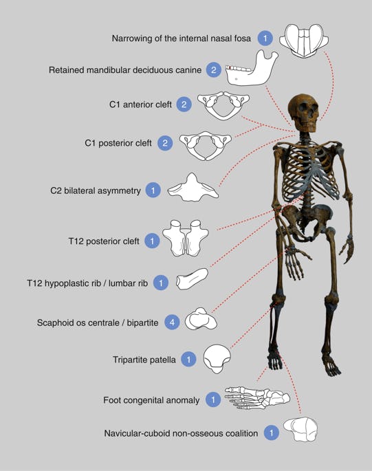 Did Inbreeding Kill the Neanderthals? Experts Say Skeletons Hold Clues