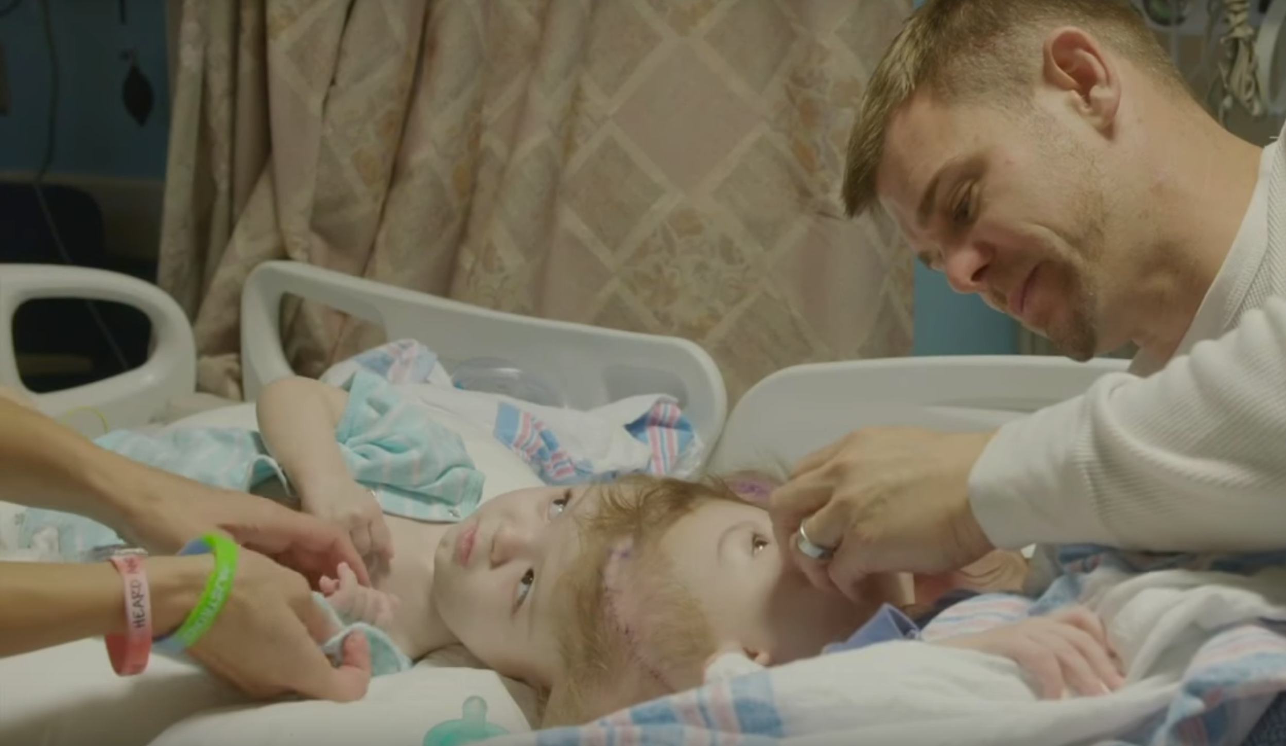 Conjoined Twins to Be Separated in Rare Surgery