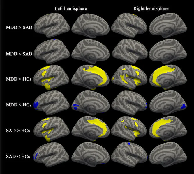 Anxiety and Depression Change Brain Structure In Similar Ways