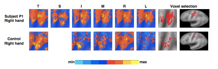 Six-Fingered Hands Show How the Brain Seamlessly Controls an Extra Digit