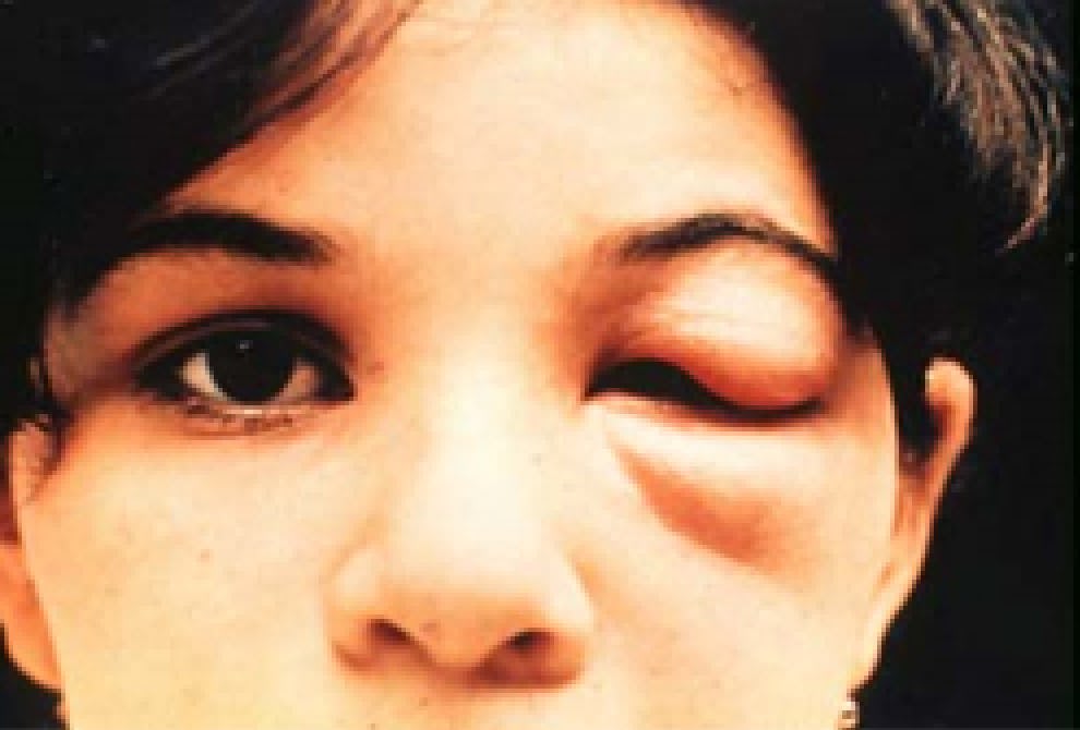 Chagas Disease: American Heart Association Warns Doctors to Be Vigilant