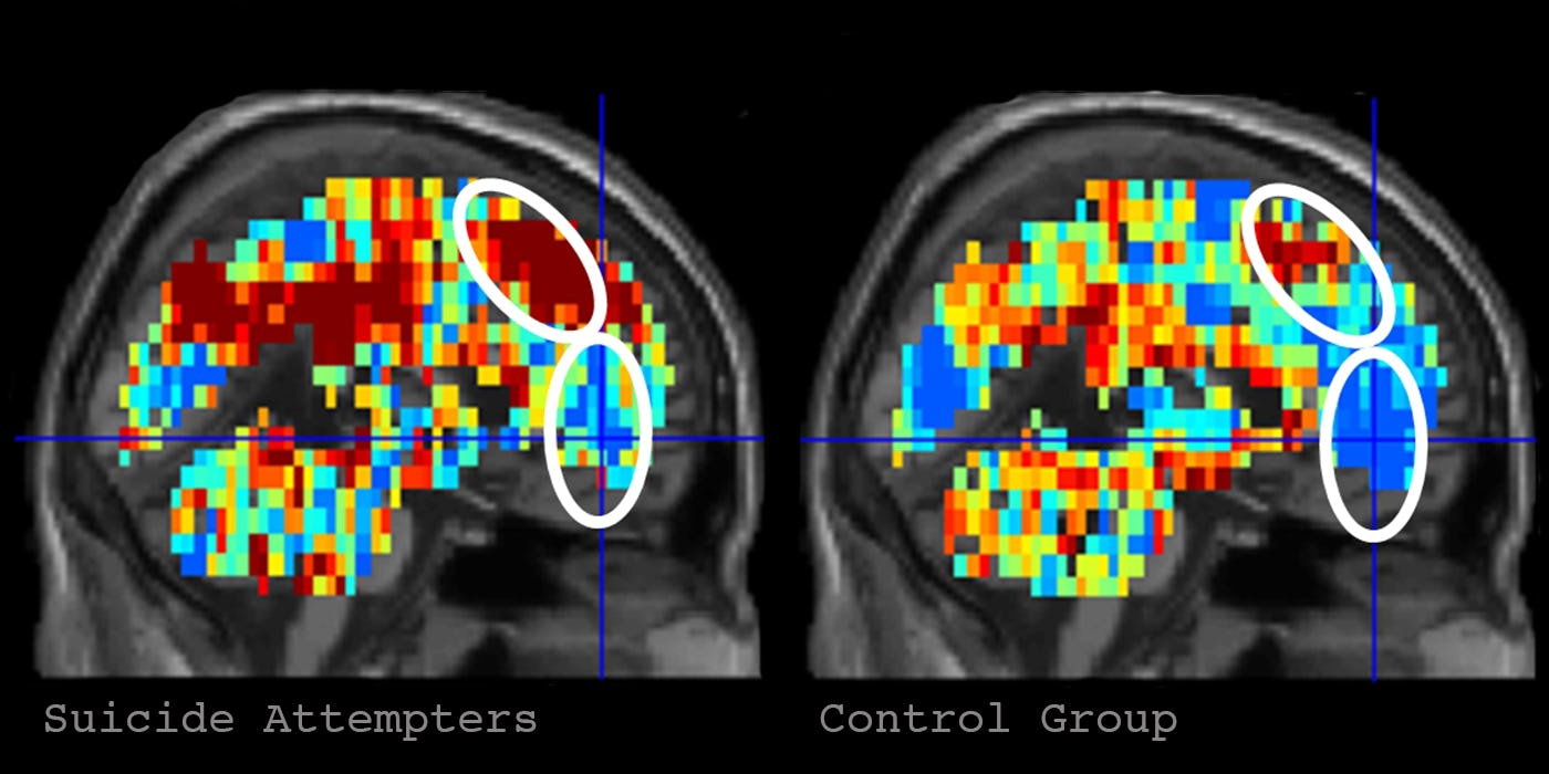 Brain Scans Can Now Identify People With Suicidal Thoughts