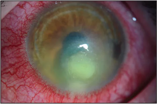 Contact Lens Lodged in Woman's Eye for 28 Years Underscores New CDC Warning