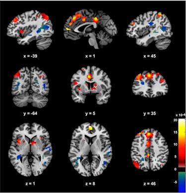 What Weed Actually Does to Your Brain: Here's What fMRI Scans Show