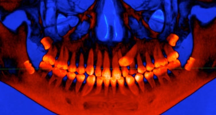 Why Do Humans Still Have Wisdom Teeth? Evolution Explains