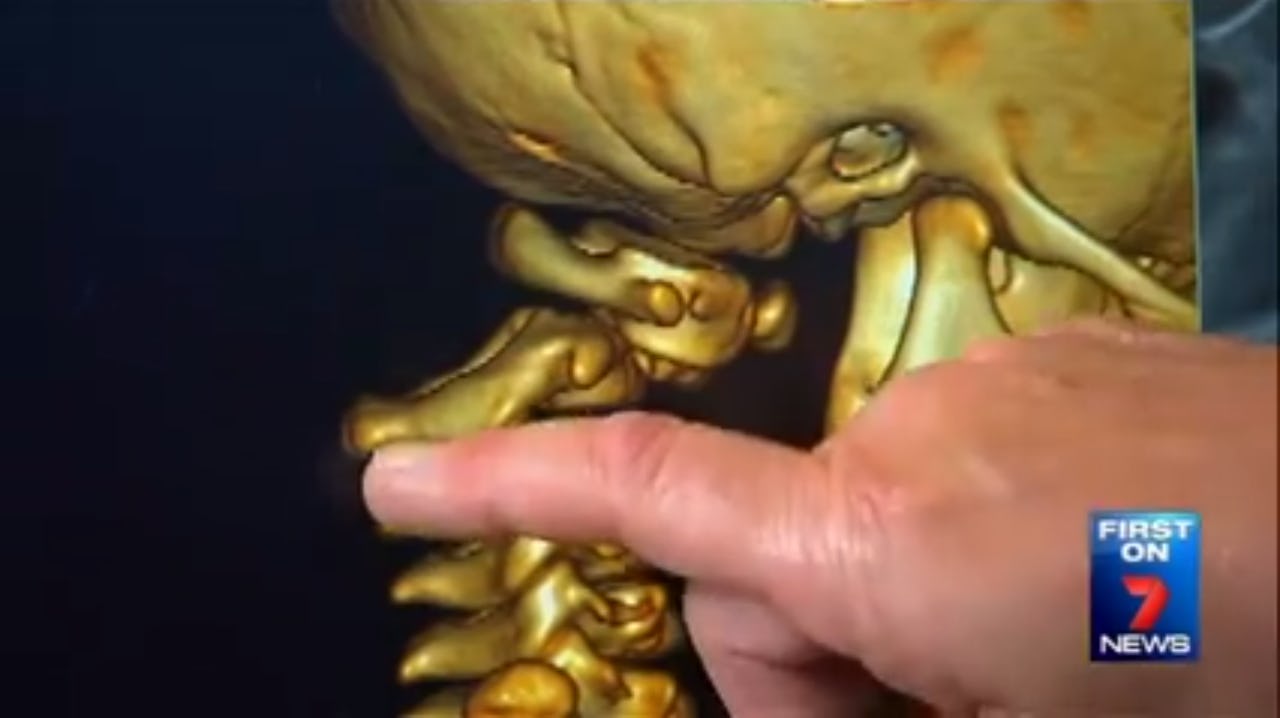 Toddler Survives 'Miracle' Internal Decapitation Surgery