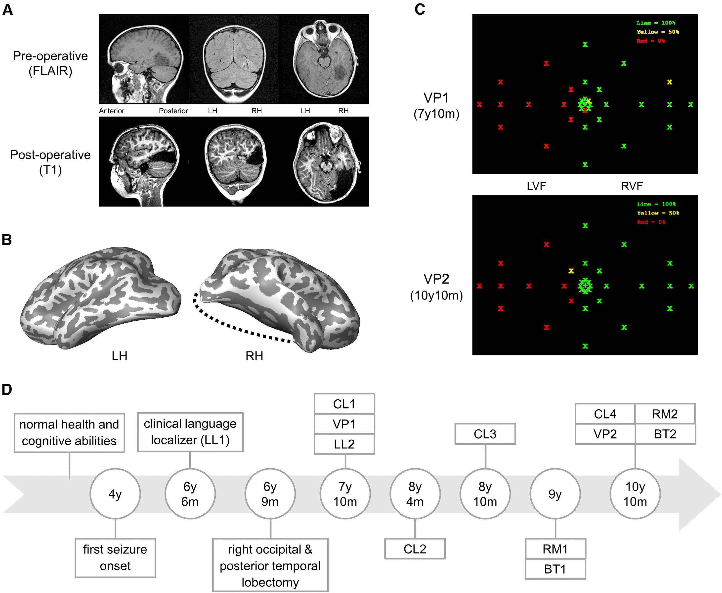 Boy Who Grew Up Missing a Chunk of His Brain Shows Incredible Plasticity