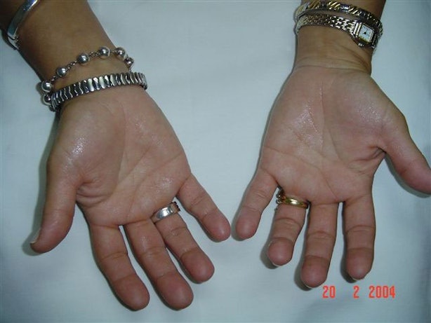 I Had Hyperhidrosis in My Hands, Feet and Underarms — And it Was a ...