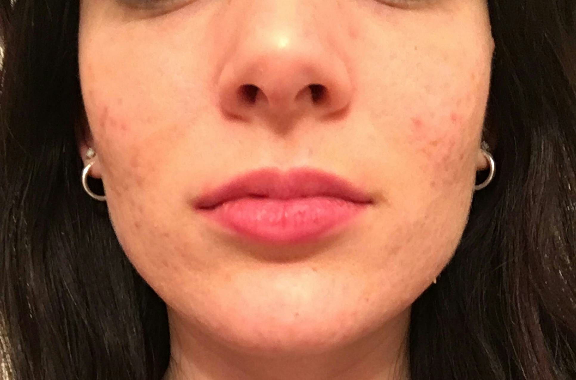 I Didn't Moisturize My Dry Skin For A Week & Here's What Happened — PHOTOS