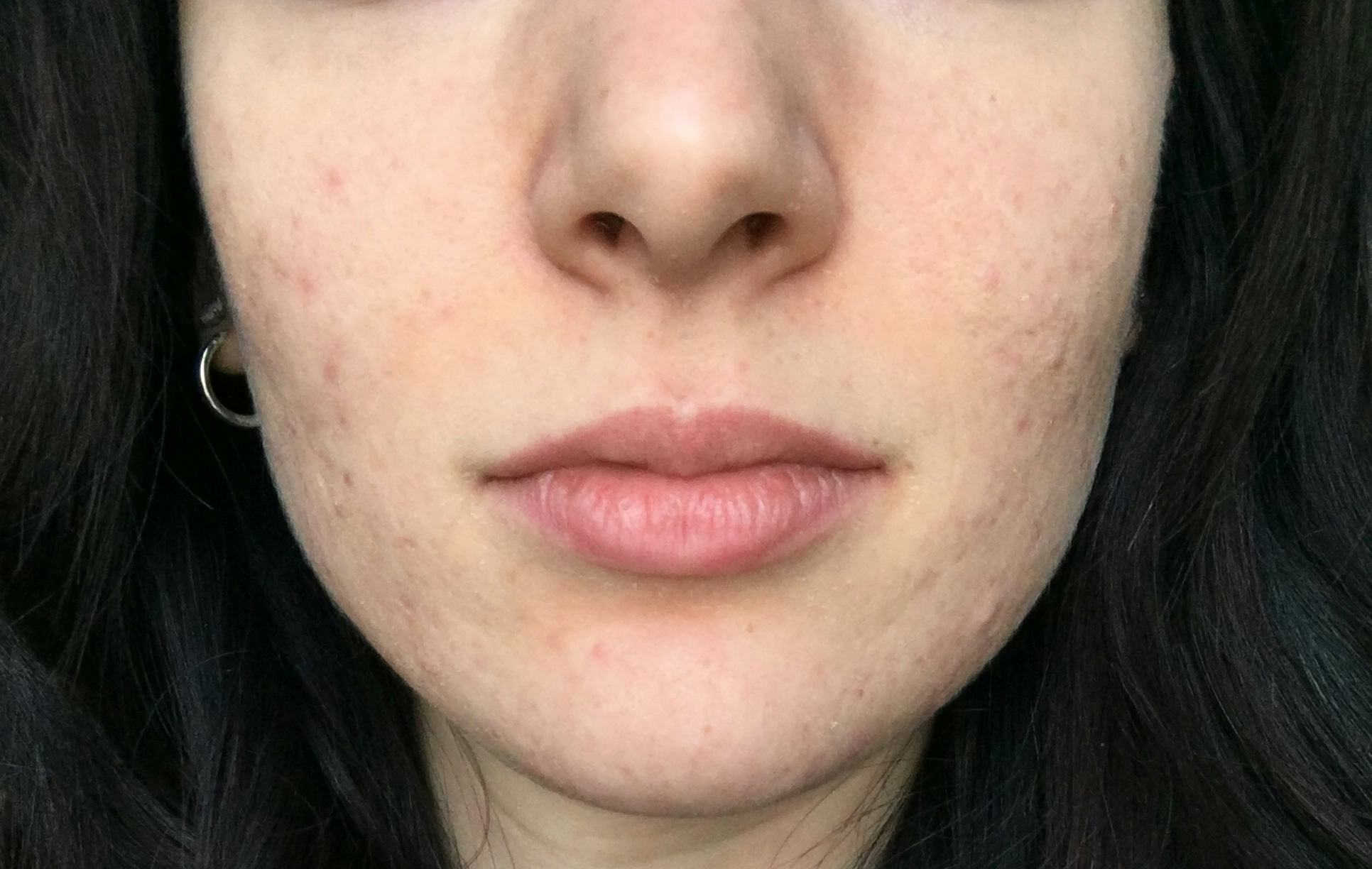 I Didn't Moisturize My Dry Skin For A Week & Here's What Happened — PHOTOS