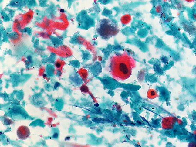 What Is An "Abnormal" Pap Smear?