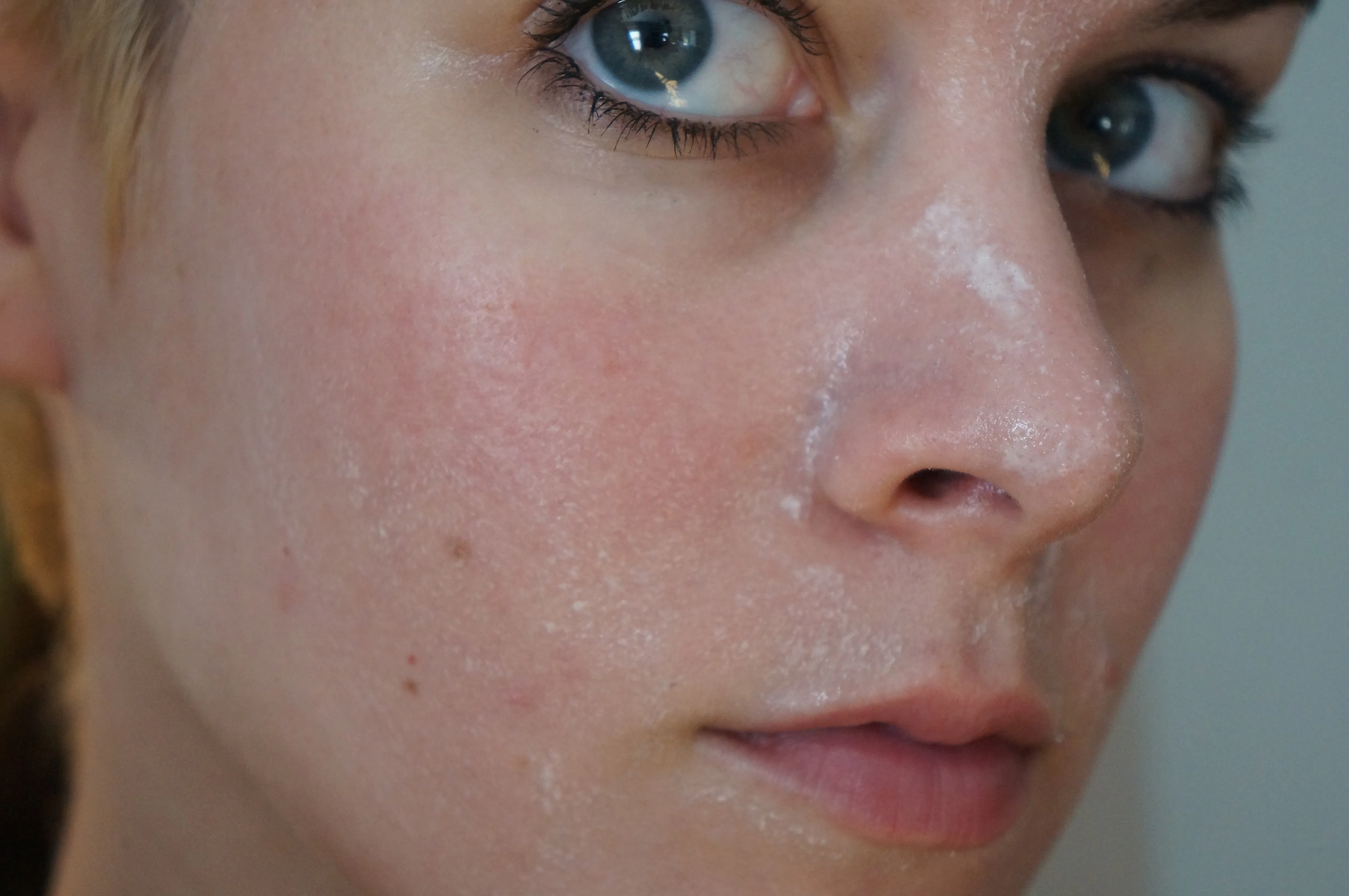 I Tried Adding Sulfur To My Skin Care Routine To Reduce The Redness On ...