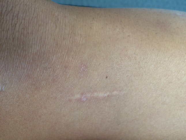 11 Reasons To Embrace Your Scars This Swimsuit Season & Beyond