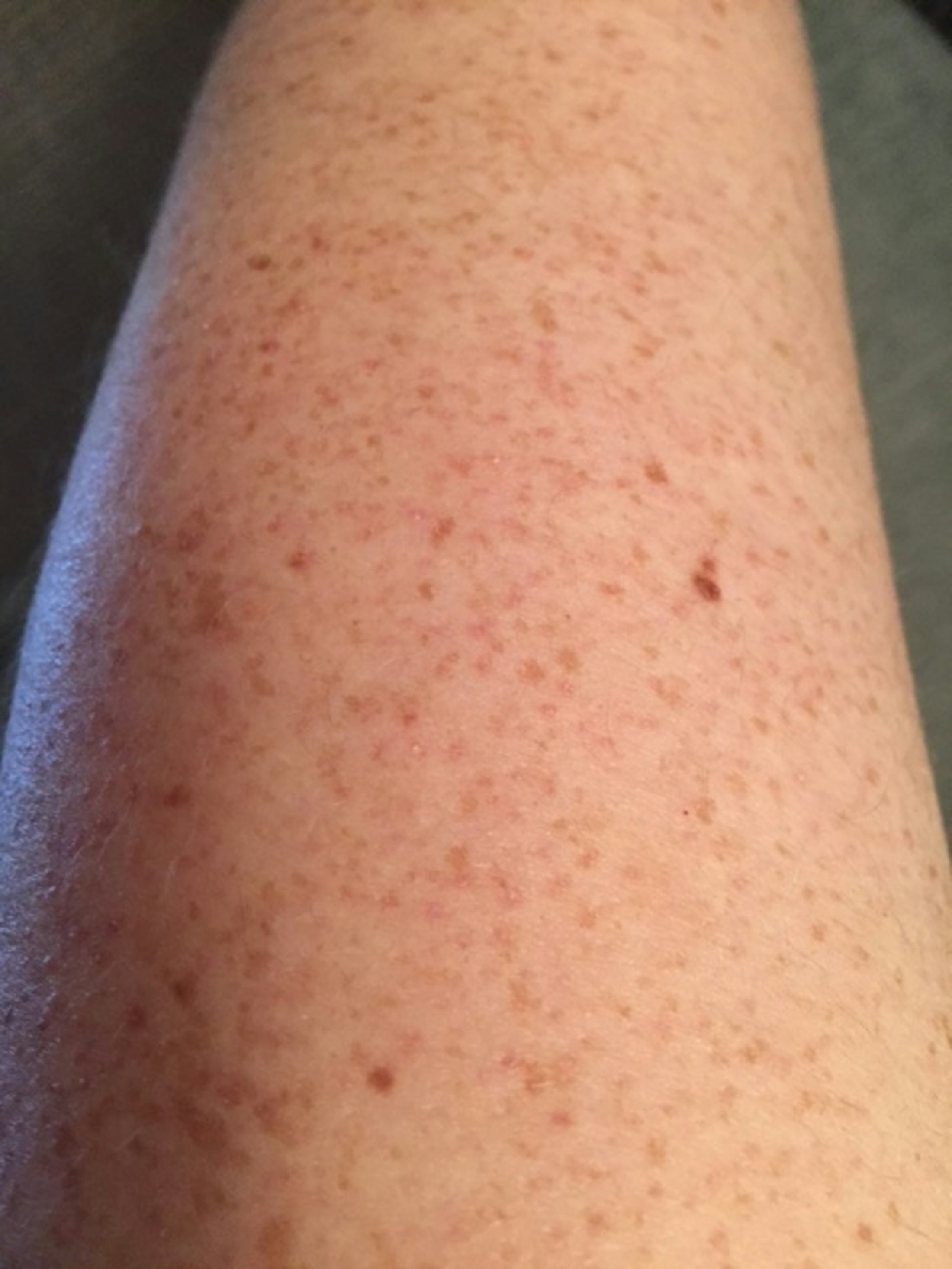 Those Bumps On Your Upper Arms Are Called Keratosis Pilaris, And They ...