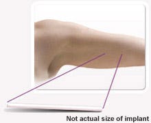 What It's Like To Get a Hormonal Implant, Also Known As The Best Birth ...