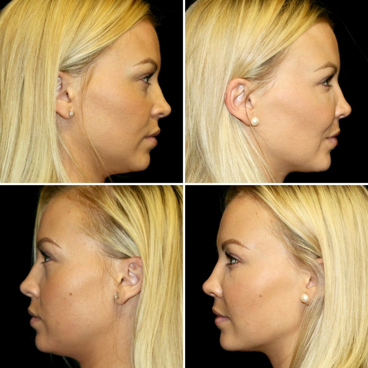 Just how revolutionary is stem cell injectable facial rejuvenation ...