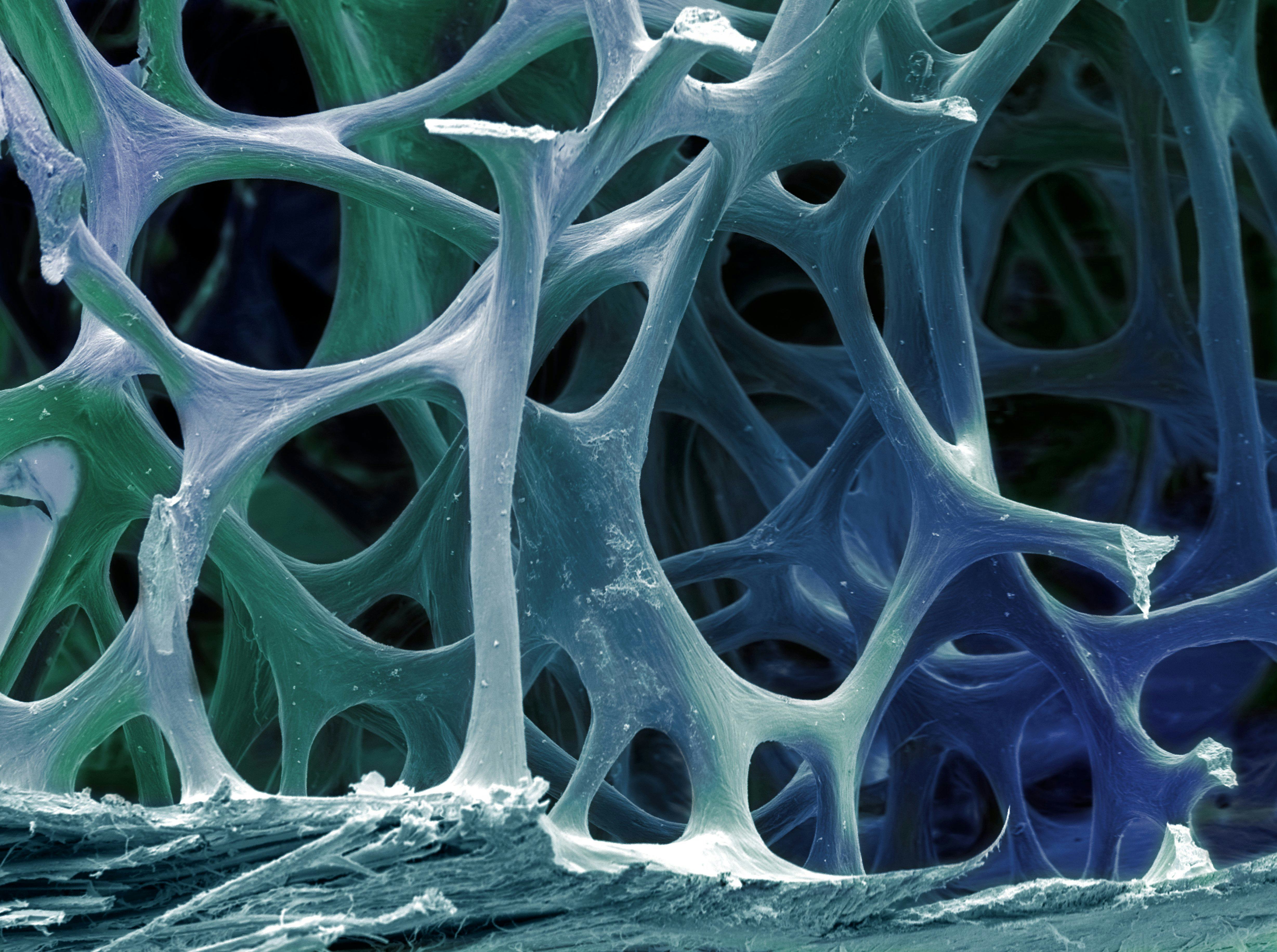 Scientists Created an Injectable Foam That Can Repair Broken Bones