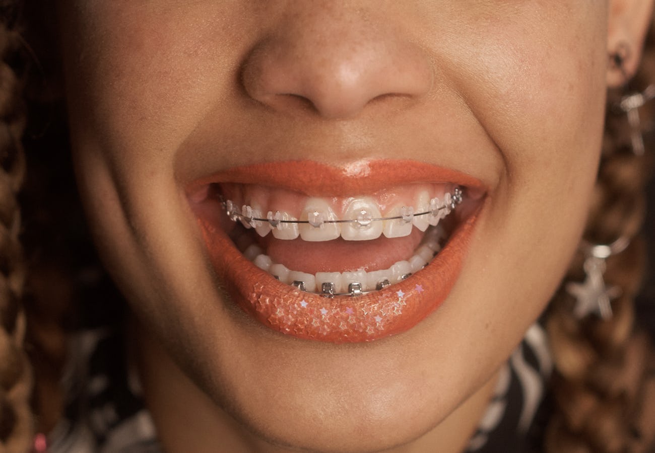 How To Rock Braces And Shine Like A Star