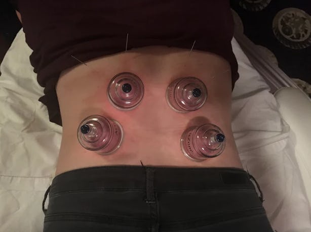 I Tried Cupping & Lived To Tell The Tale — PHOTOS