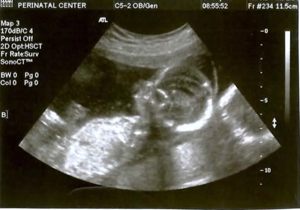 When I Learned My Baby Would Be Born With A Birth Defect