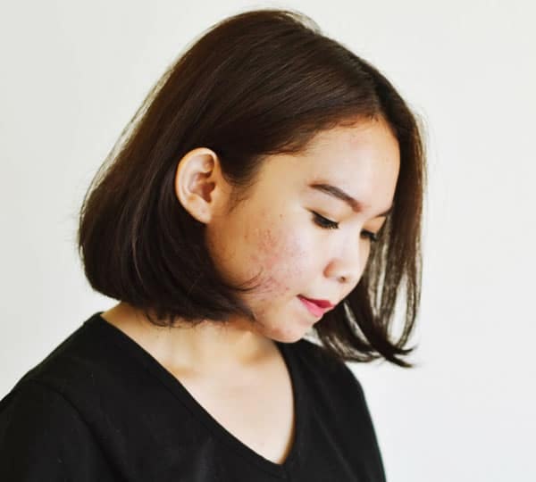 Postpartum Acne Is Common, But It Still Totally Sucks