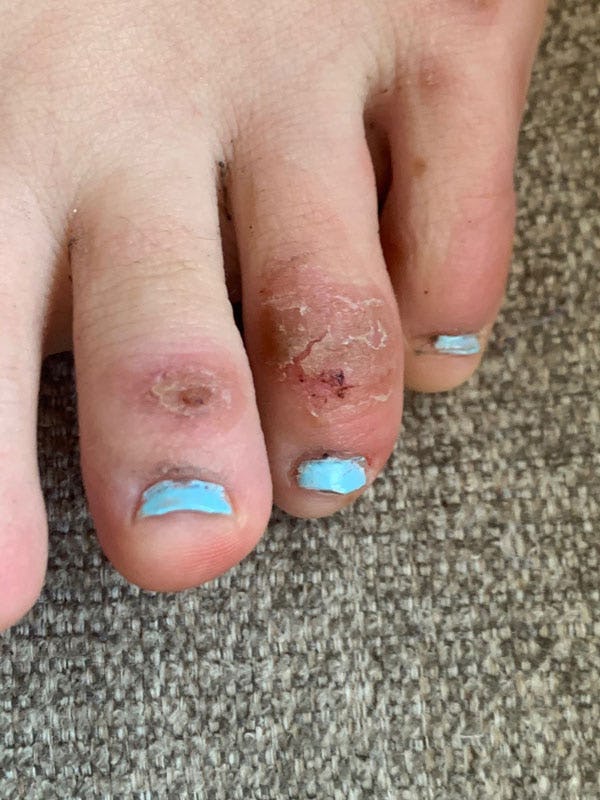 Doctors Weigh In On ‘COVID Toes’ And What To Look For