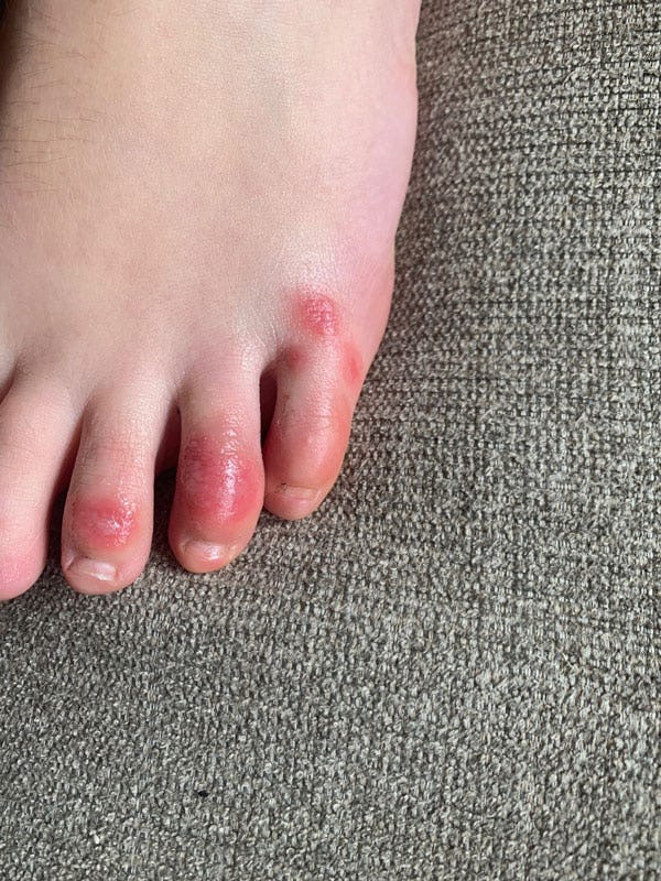 Doctors Weigh In On ‘COVID Toes’ And What To Look For