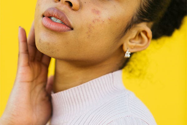 The ‘Influencer’ Trend We Freaking Love—Showing Our Real Skin