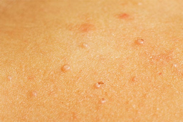 Molluscum Is The Childhood Rash We All Dread — But It’s Going To Be OK ...